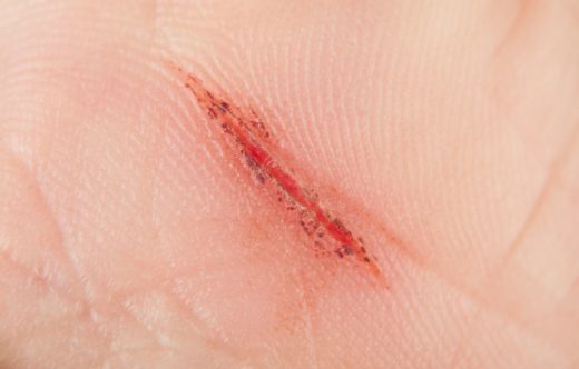 Cicatrisation : les étapes, comprendre pour mieux soigner