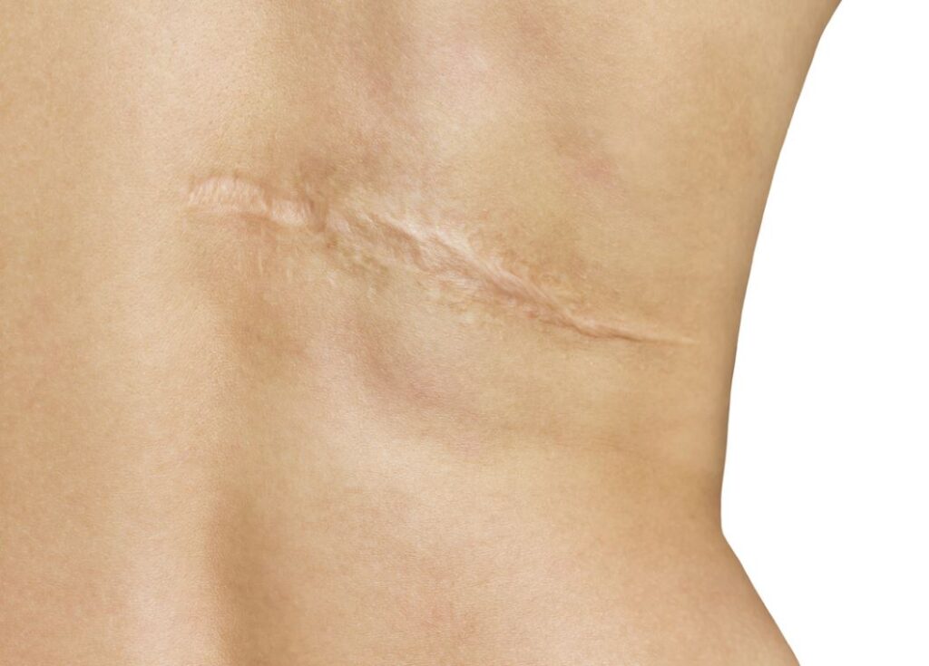 Cicatrices : pourquoi il est nécessaire d'agir rapidement